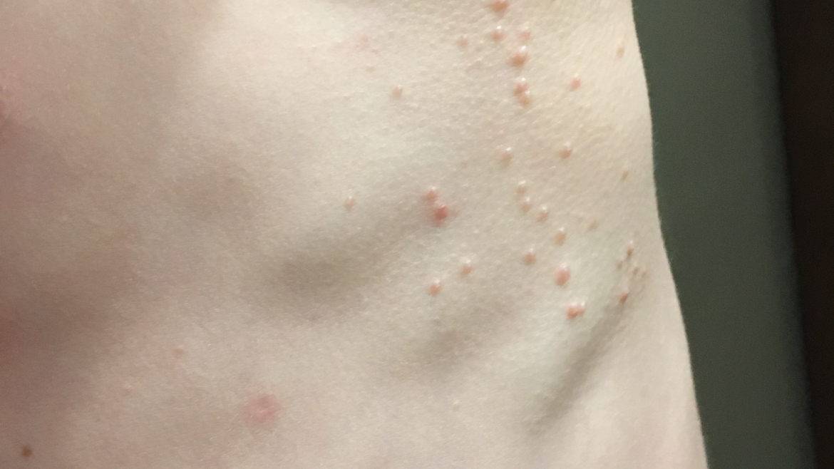 Molluscum Contagiosum Renew Dermatology Birmingham AL Based Molluscum Contagiosum Renew Dermatology Birmingham AL Based