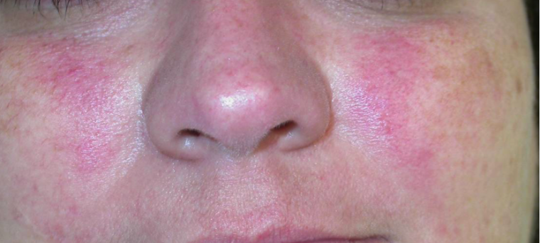 Top 5 Triggers of Rosacea to Avoid - Renew Dermatology - Birmingham AL ...