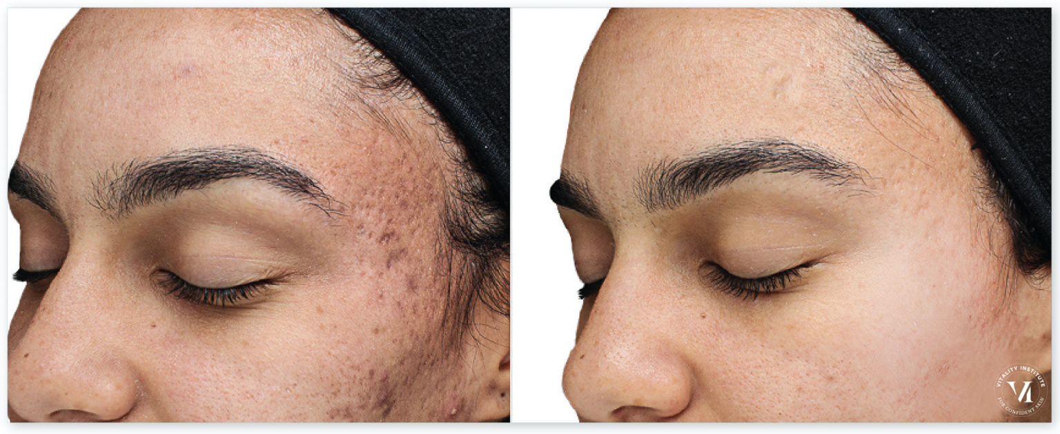 VI Peel Purify with Precision Plus - Renew Dermatology - Birmingham AL ...